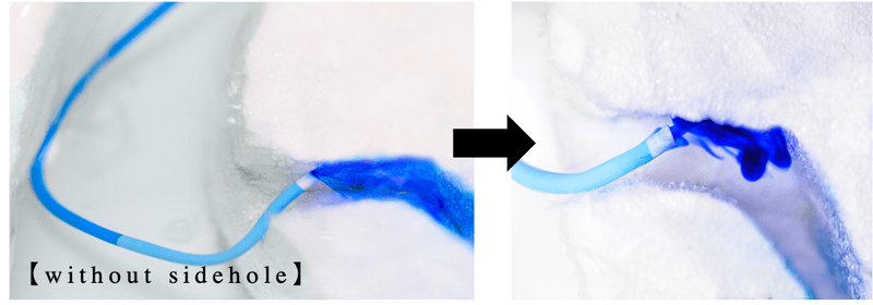 Use Case for the Technowood SoftNAV Judkins Safety Catheter
